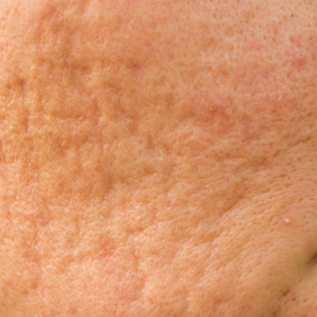 Littekens effectief thuis verzorgen - paramedisch skincare – Derm Medics